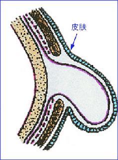 神经管畸形_360百科